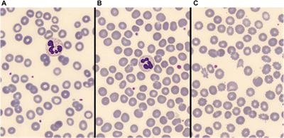Frontiers | Red Blood Cell Morphologic Abnormalities in Patients ...