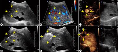 Frontiers | Ultrasound-guided thermal ablation versus laparoscopic ...