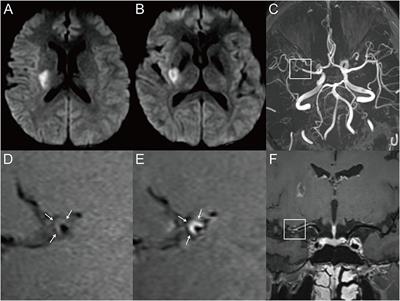 Frontiers | Wall characteristics of atherosclerotic middle cerebral ...