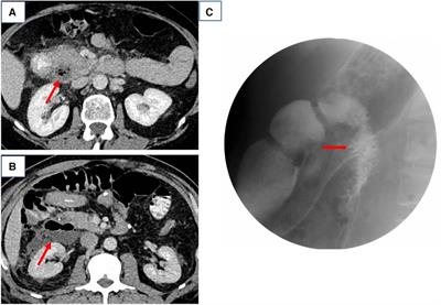 Frontiers | Spontaneous perforation of a primary duodenal diverticulum ...