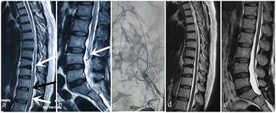 Frontiers | Spinal dural arteriovenous fistula: A rare but treatable ...