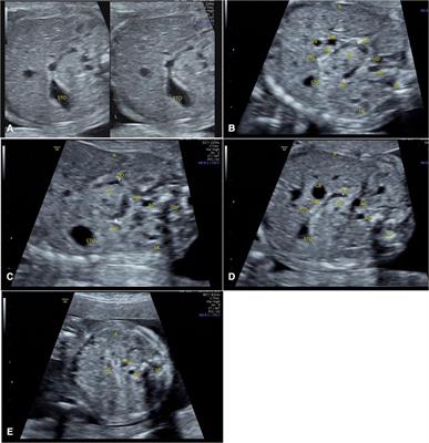 Frontiers | Ultrasound examination of the normal fetal duodenum