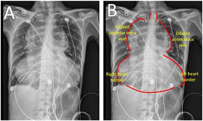Total Anomalous Pulmonary Venous Return Without Obstruction