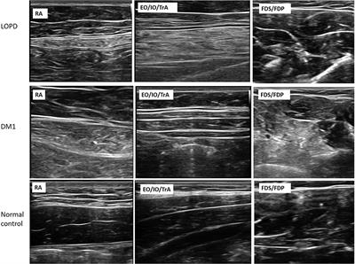 Frontiers | Ultrasonography of abdominal muscles: Differential ...
