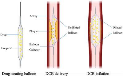 Frontiers | The factors influencing the efficiency of drug-coated balloons