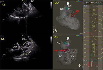 Frontiers | Electrocardiographic criteria for localization of ...