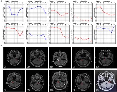 Frontiers | Sudden sensorineural hearing loss as the initial symptom in ...
