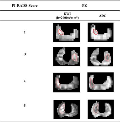 Frontiers | Machine learning-based analysis of a semi-automated PI-RADS ...