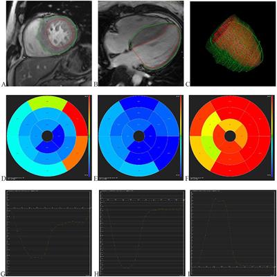 Frontiers | Left ventricular strain patterns and their relationships ...