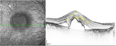 Frontiers | Association between inflammatory cytokines in the aqueous ...