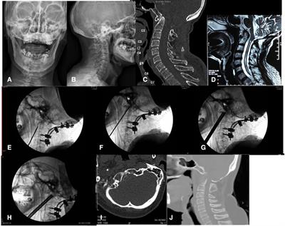 Frontiers | Full-endoscopic uniportal retropharyngeal odontoidectomy: A ...
