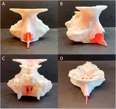 Frontiers | Assessment of a novel patient-specific 3D printed multi ...