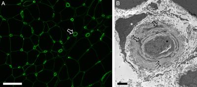 Frontiers | Scleromyositis: A distinct novel entity within the systemic ...