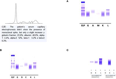 Frontiers | Case Report: A case of IgD lambda/lambda Multiple Myeloma ...