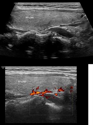 Parathyroid Tumor Ultrasound