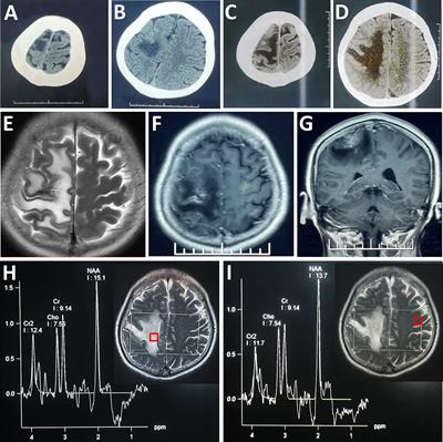 Frontiers | Case Report: Surgical thrombectomy in a patient with ...