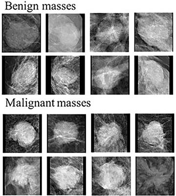 Breast Cancer Mammogram