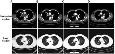 Frontiers | Large mediastinal mass diagnosed as Nocardia infection by ...