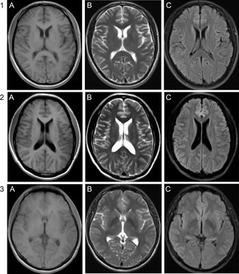 Frontiers | Neurosyphilis with ocular involvement and normal magnetic ...