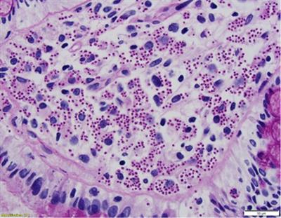 Coccidioidomycosis Histology