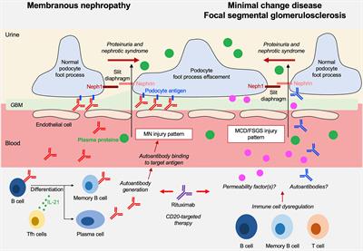 Frontiers | Editorial: Immune dysfunction in nephrotic syndrome ...