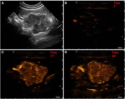 Frontiers | Contrast-enhanced ultrasound features of focal pancreatic ...