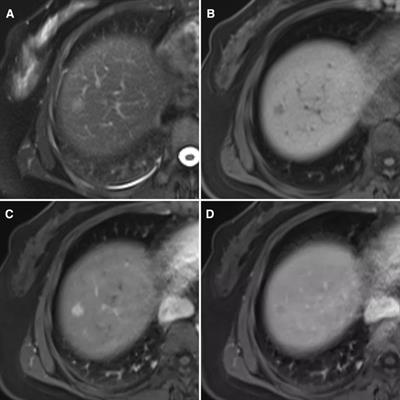 Frontiers | Case report: Hepatic epithelioid angiomyolipoma with ...