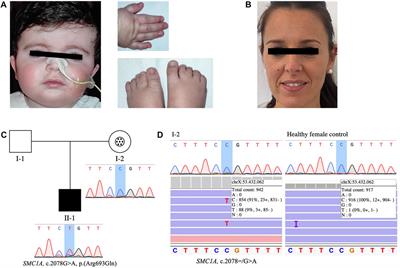 Frontiers | Case report: A novel case of parental mosaicism in SMC1A ...