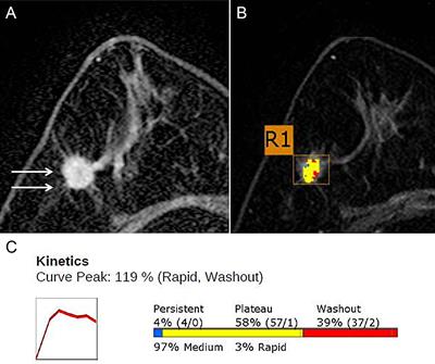 Frontiers | The road to breast cancer screening with diffusion MRI