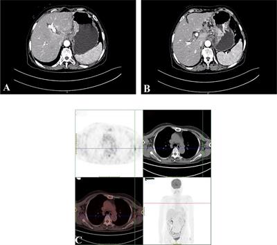 Frontiers | Rare metastasis of gastric cancer to the axillary lymph ...