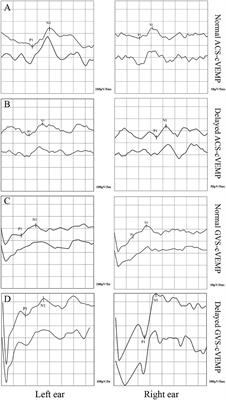 Frontiers | Potential vestibular pathway impairment in children with ...