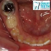 Molar Hypomineralisation and Chalky Teeth: From Developmental ...