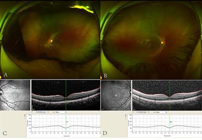 Frontiers | X-linked FRMD7 gene mutation in idiopathic congenital ...